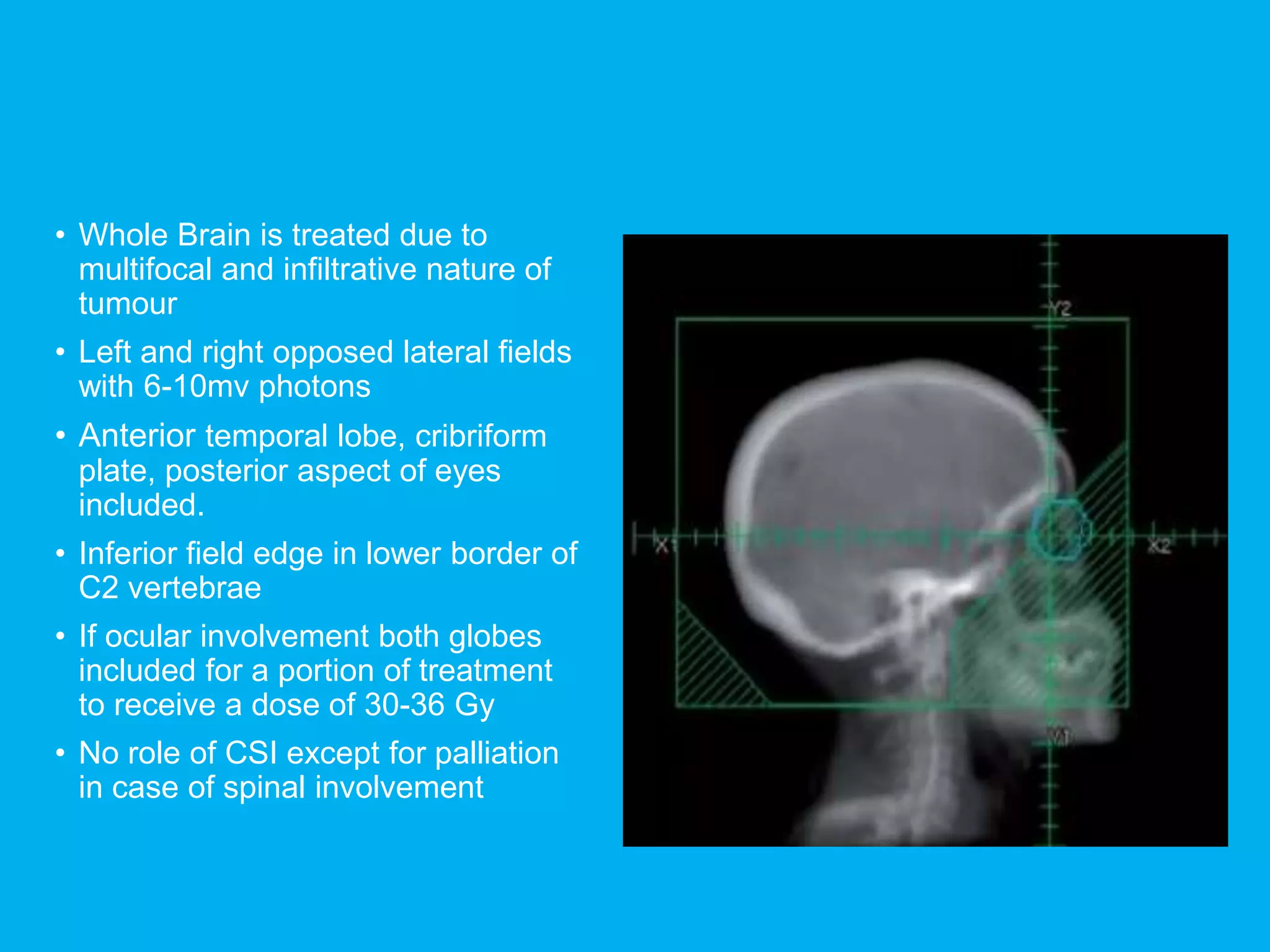 Primary CNS Lymphoma | PPTX