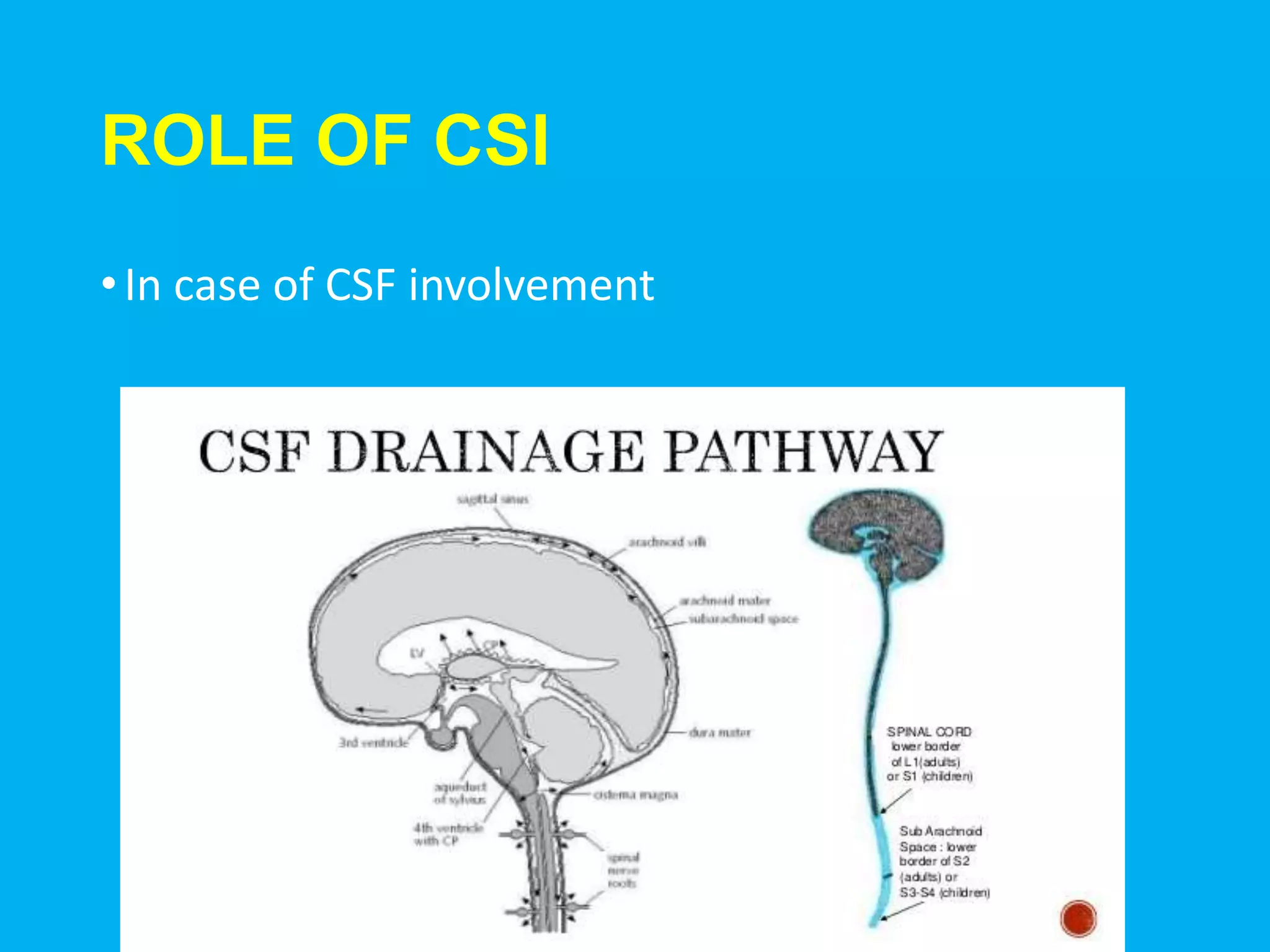 Primary CNS Lymphoma | PPTX