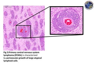 Primary cns lymphoma ppt | PPTX