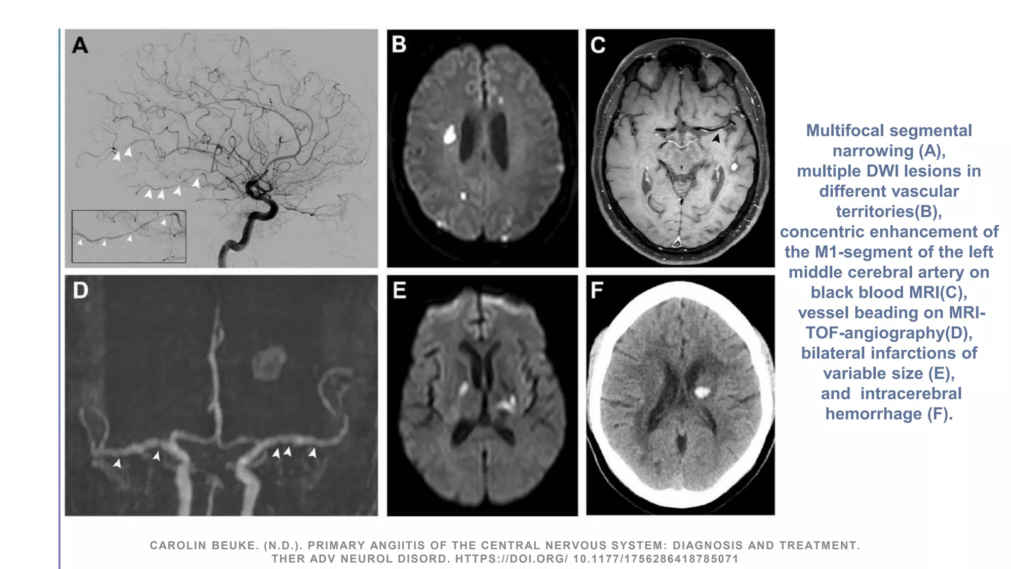 Primary cns vasculitis | PPTX