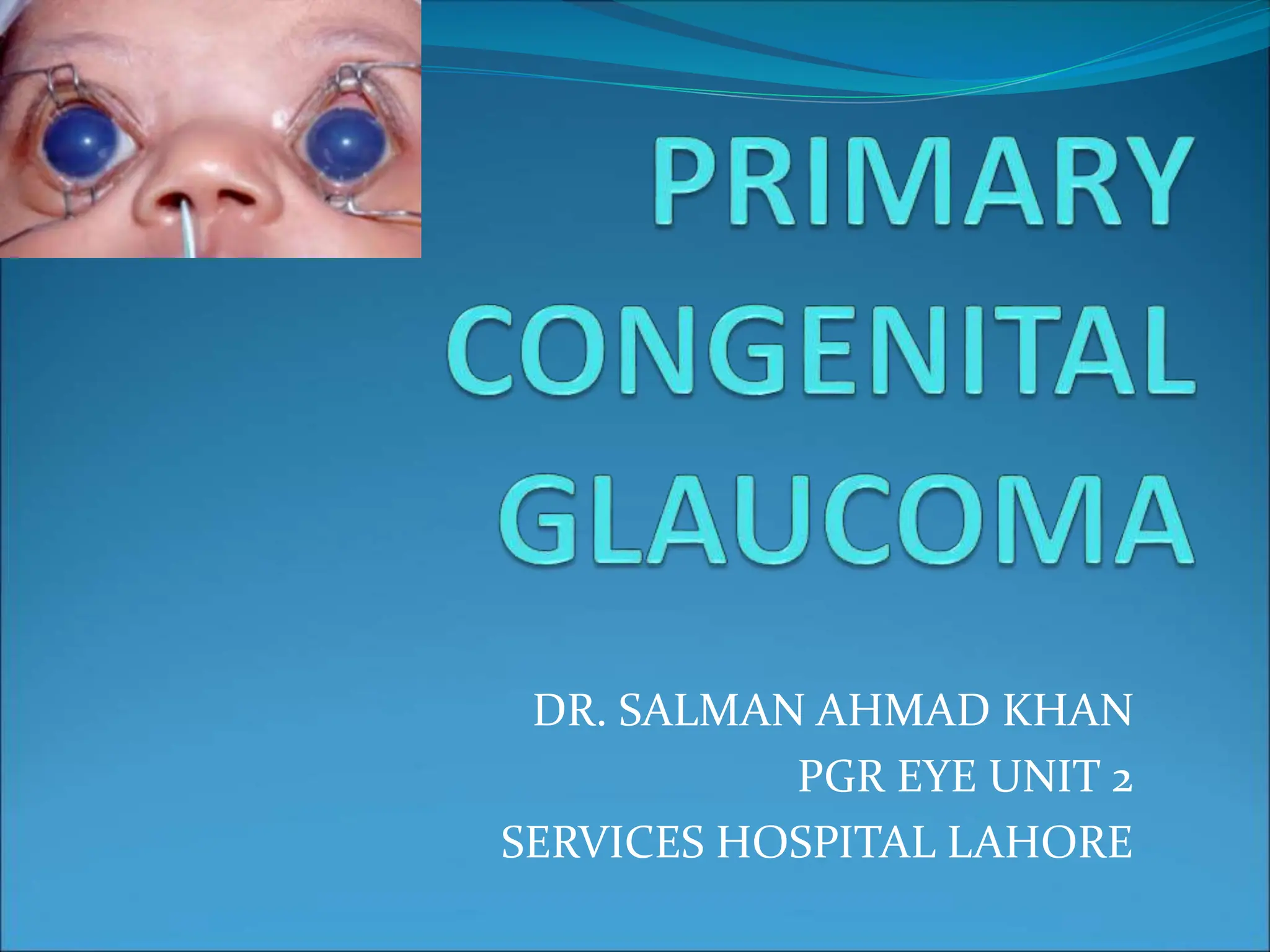 PRIMARY CONGENITAL GLAUCOMA.ppt