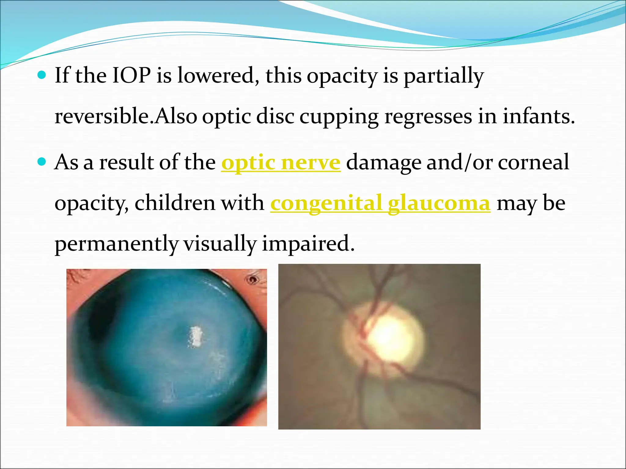 PRIMARY CONGENITAL GLAUCOMA.ppt