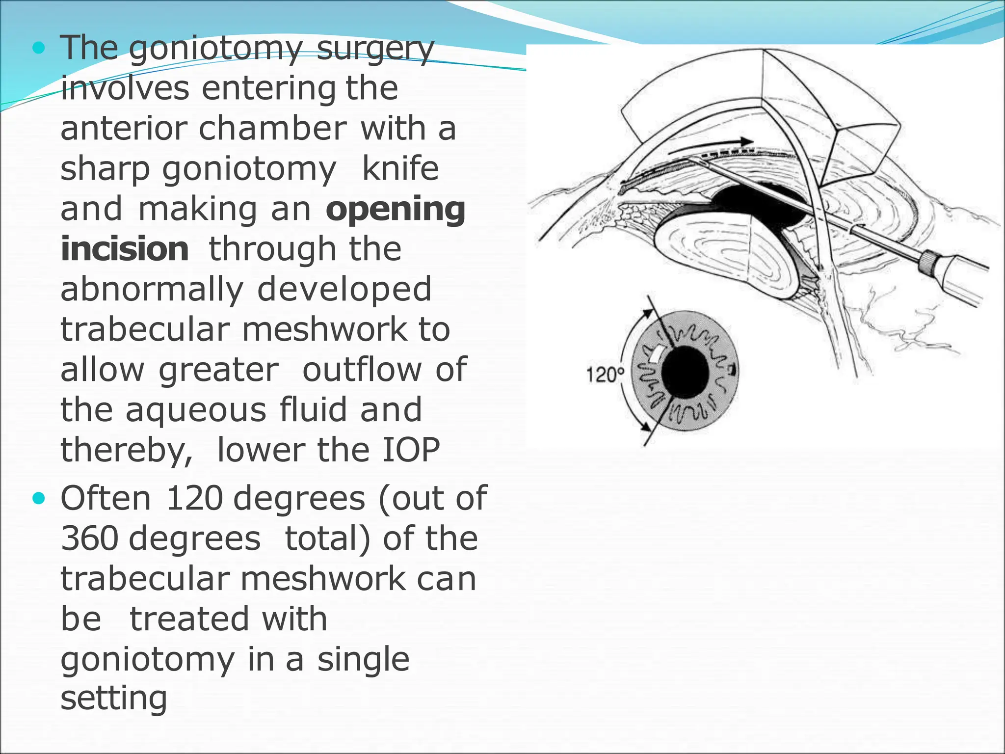 PRIMARY CONGENITAL GLAUCOMA.ppt