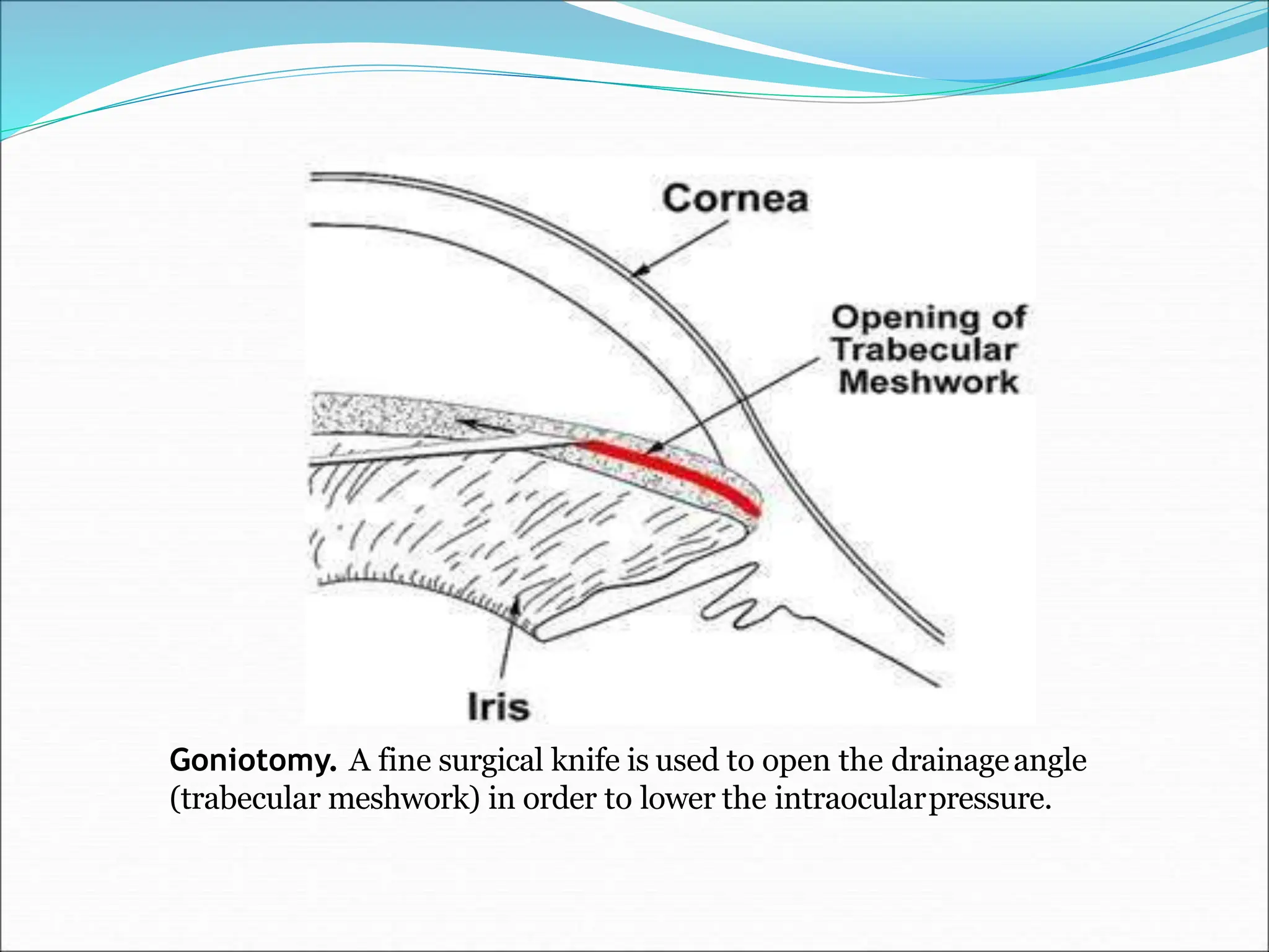 PRIMARY CONGENITAL GLAUCOMA.ppt