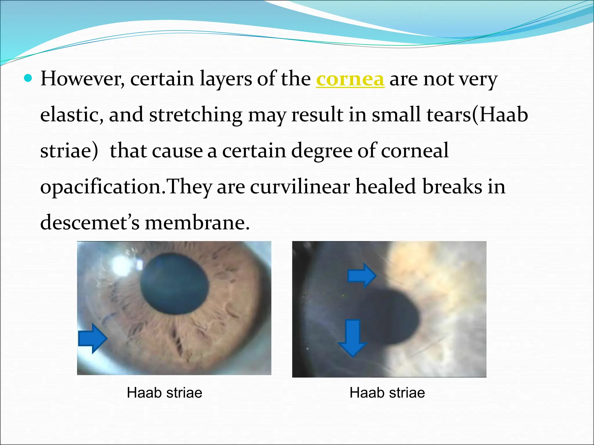 PRIMARY CONGENITAL GLAUCOMA.ppt