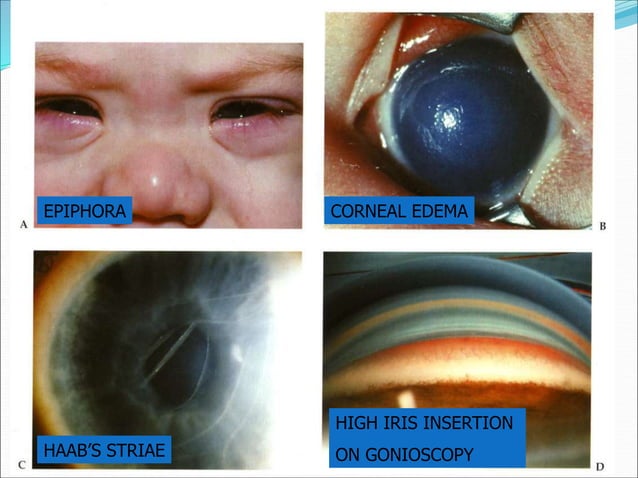 PRIMARY CONGENITAL GLAUCOMA.ppt