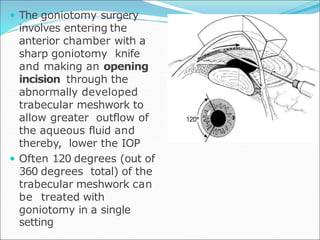 PRIMARY CONGENITAL GLAUCOMA.ppt