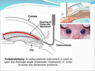 PRIMARY CONGENITAL GLAUCOMA.ppt