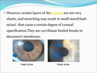 PRIMARY CONGENITAL GLAUCOMA.ppt