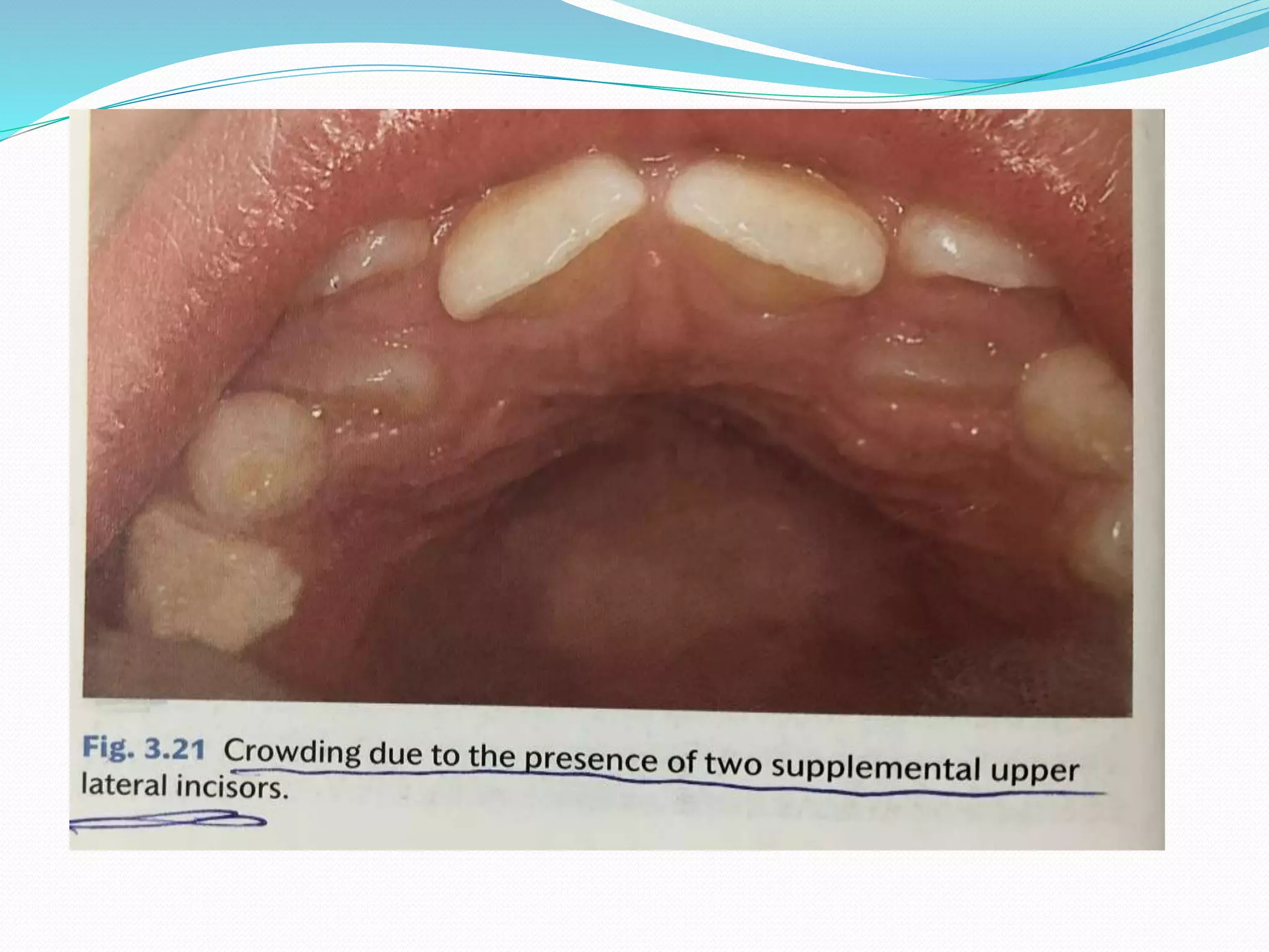 Primary crowding.pptx