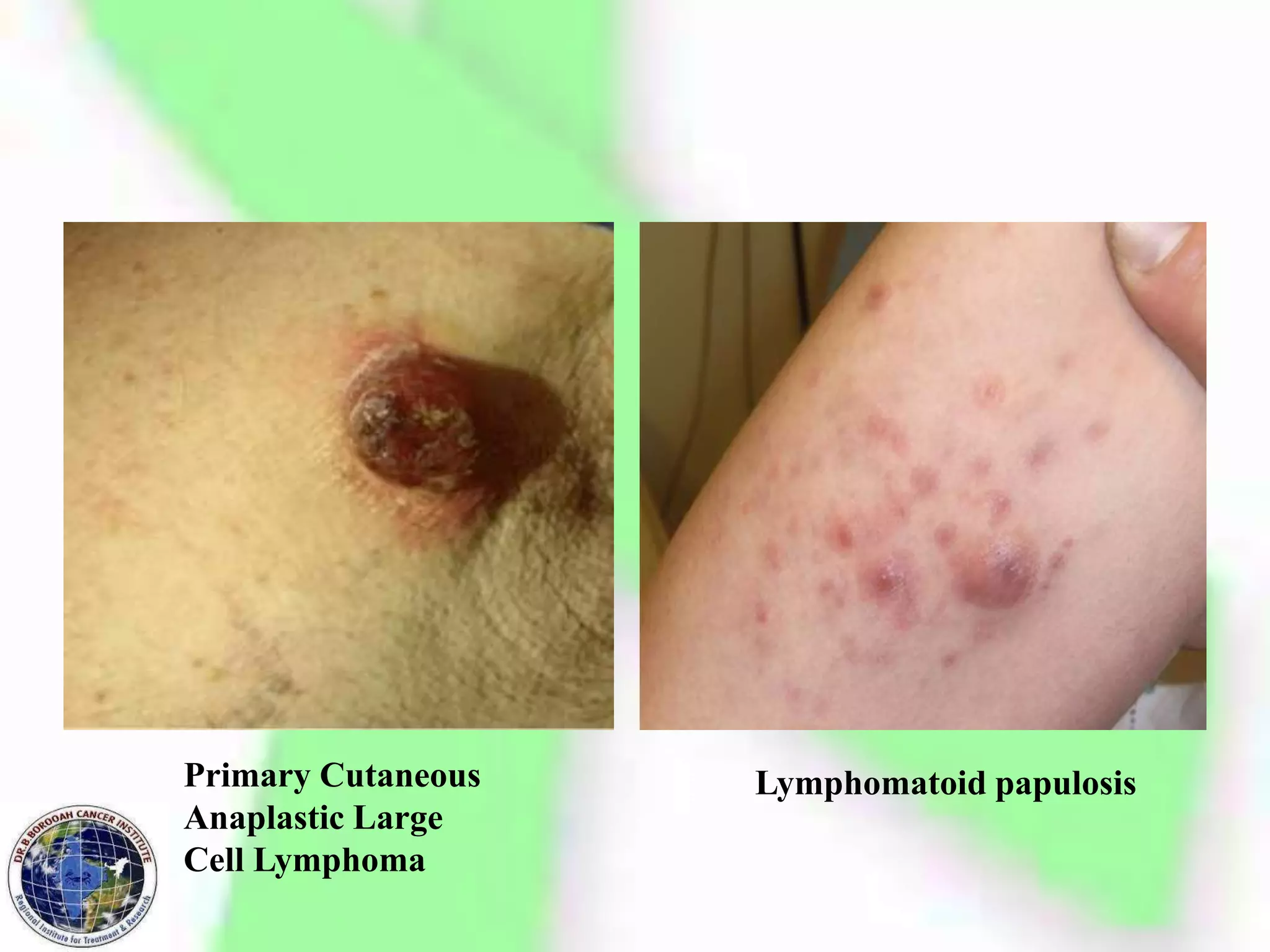 Primary cutaneous lymphoma | PPTX