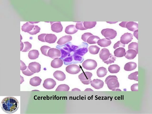 Primary cutaneous lymphoma