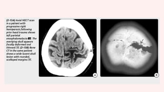 Neuroimaging in Traumatic Brain Injury: Primary effects of CNS Trauma ...