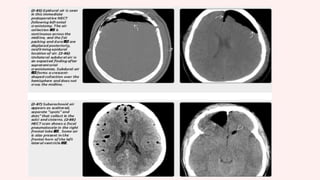 Neuroimaging in Traumatic Brain Injury: Primary effects of CNS Trauma ...