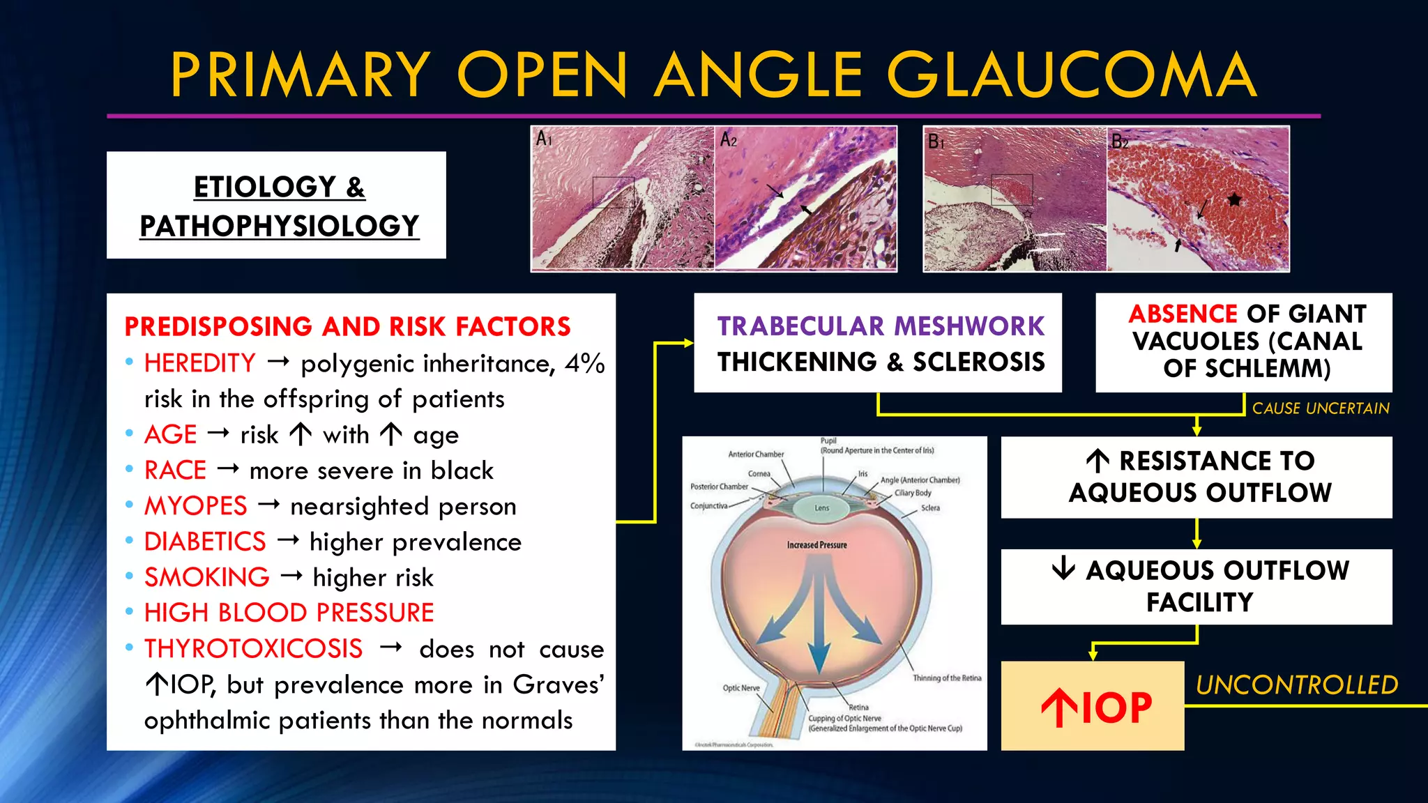 Primary Glaucoma | PDF