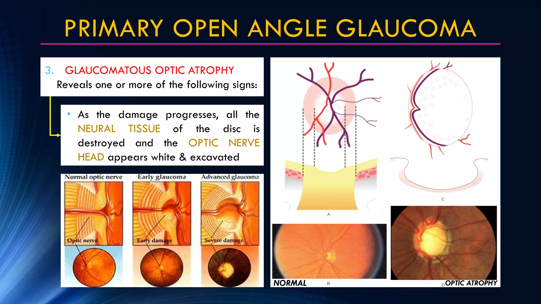 Primary Glaucoma | PDF