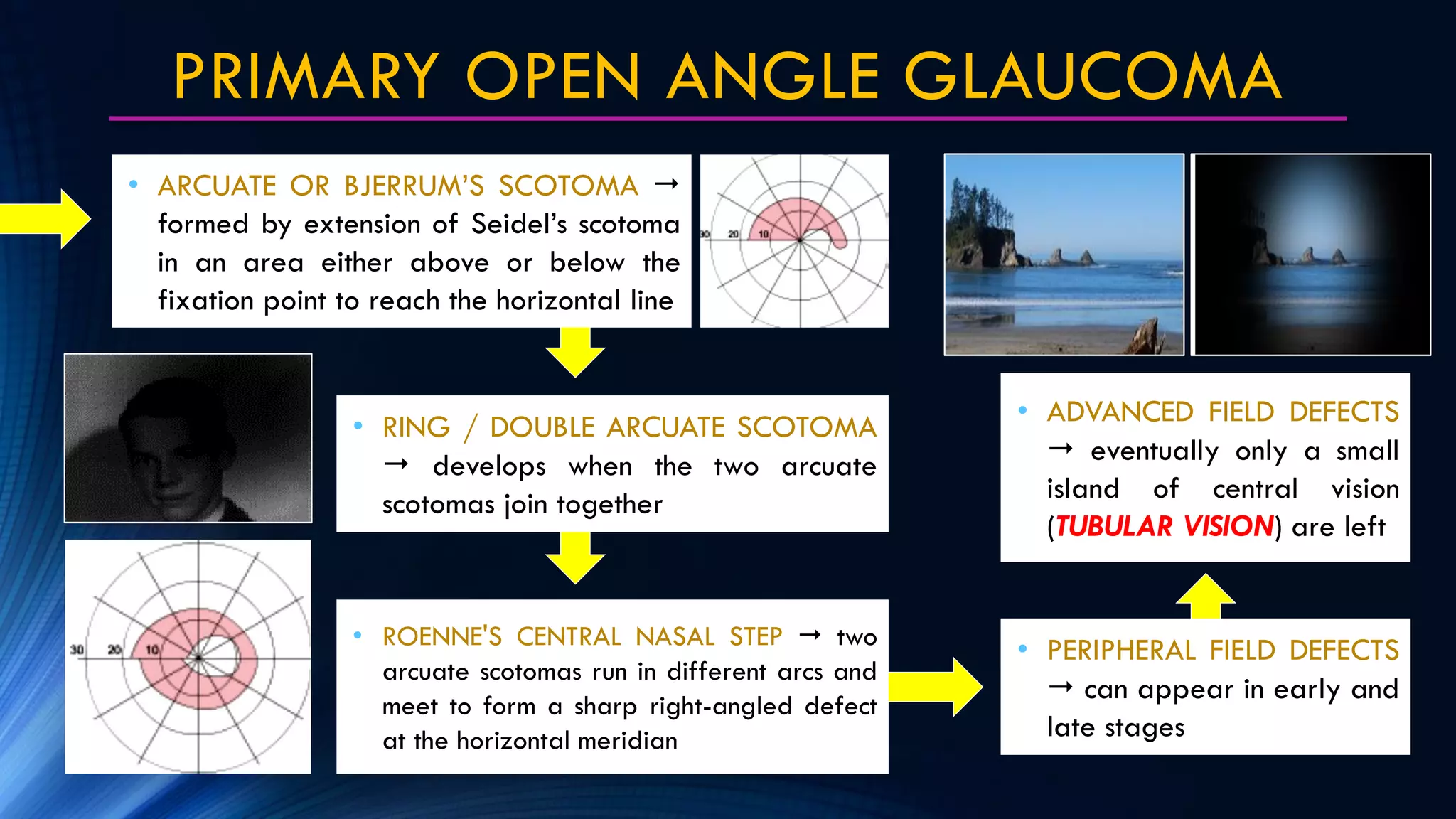 Primary Glaucoma | PDF