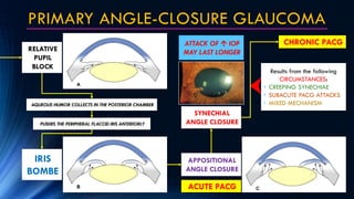 Primary Glaucoma | PDF