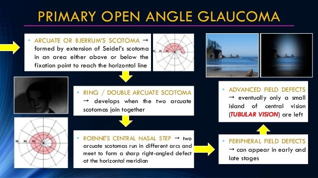 Primary Glaucoma