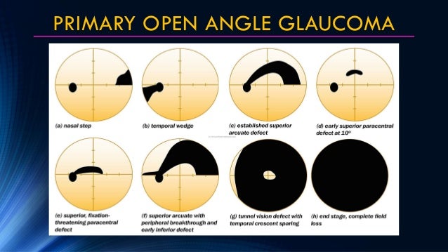Primary Glaucoma