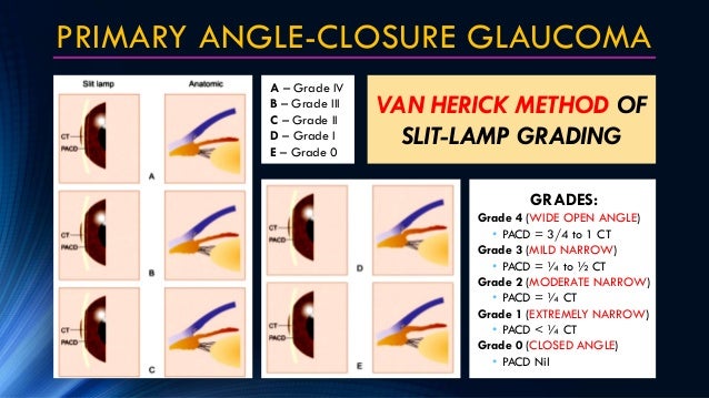 Primary Glaucoma