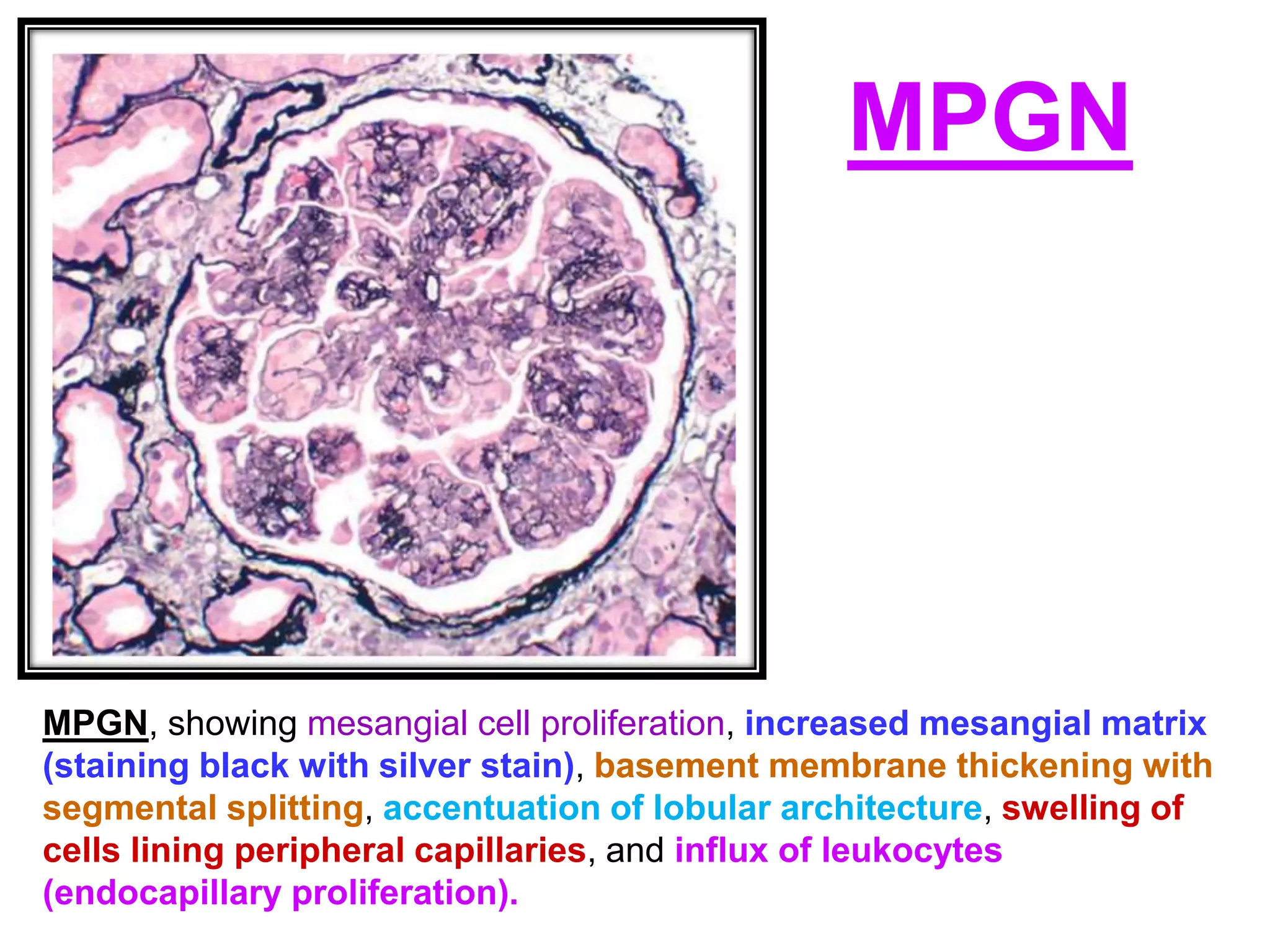 Primary glomerulonephritis | PPTX