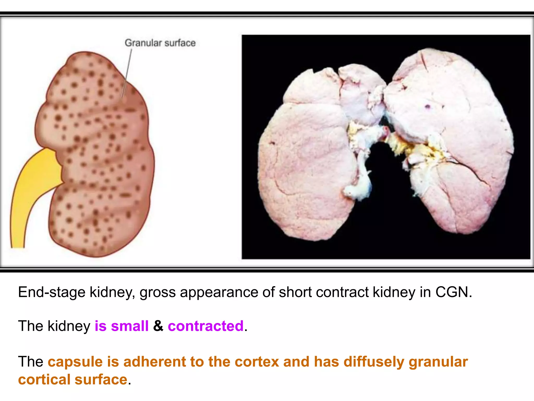 Primary glomerulonephritis | PPTX