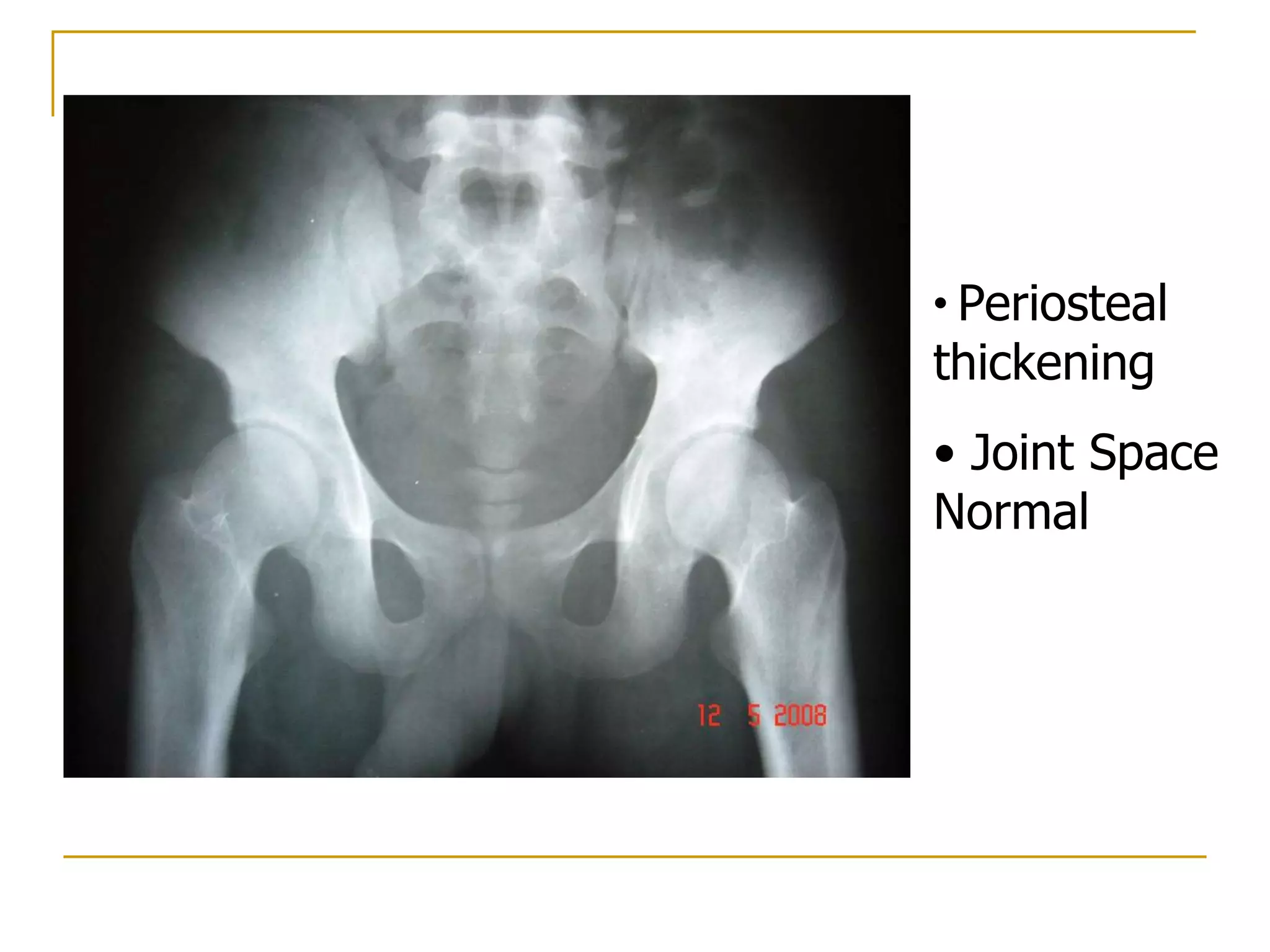 Primary hypertrophic osteoarthropathy (hpoa) | PPT