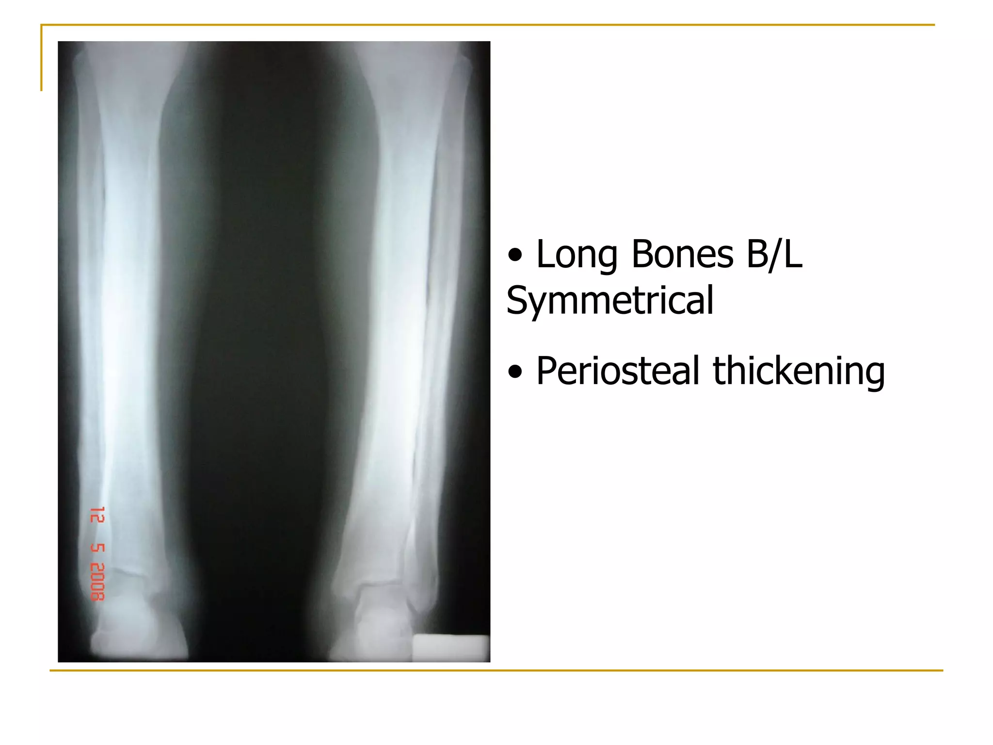 Primary hypertrophic osteoarthropathy (hpoa) | PPT