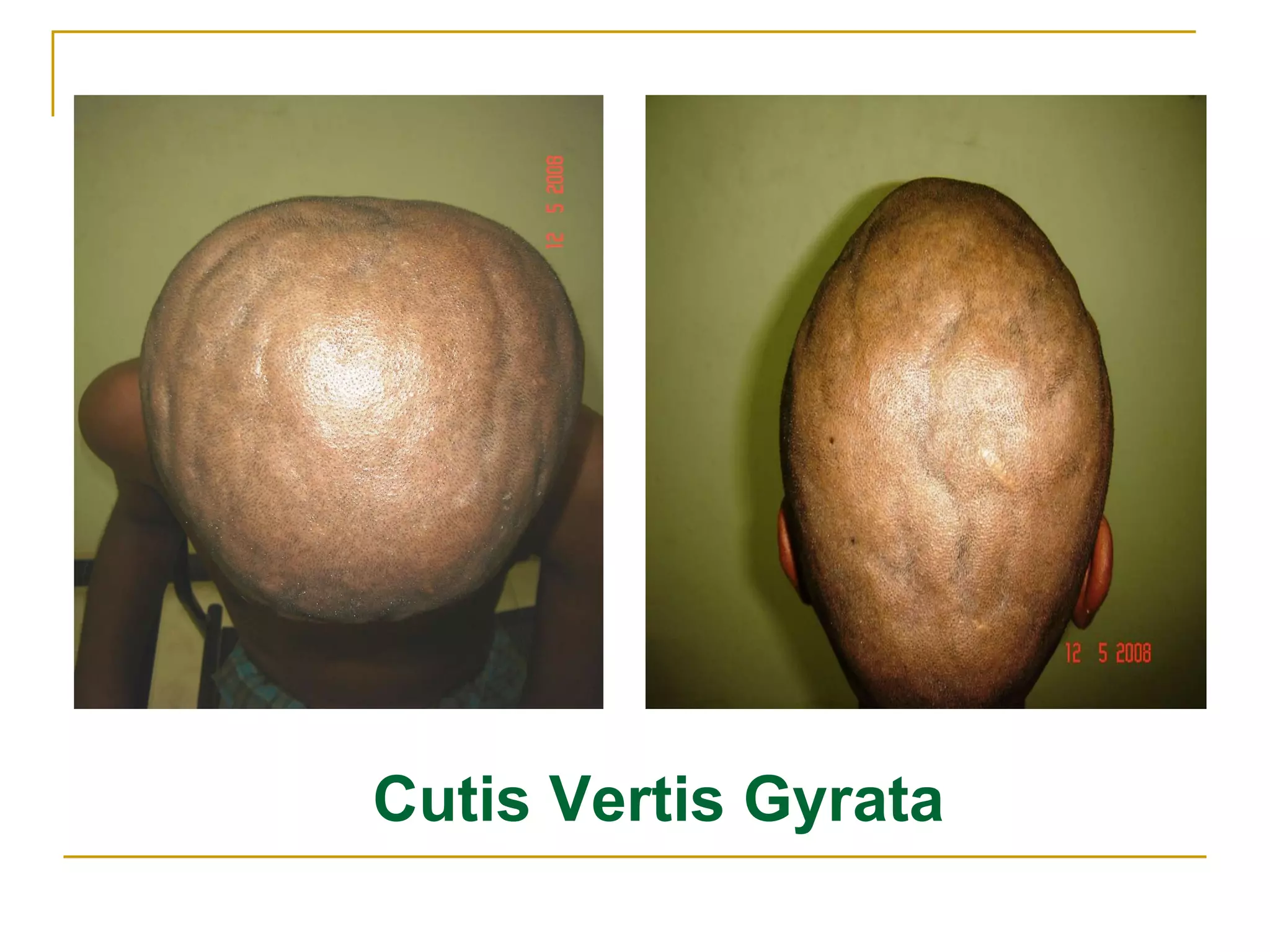 Primary hypertrophic osteoarthropathy (hpoa) | PPT