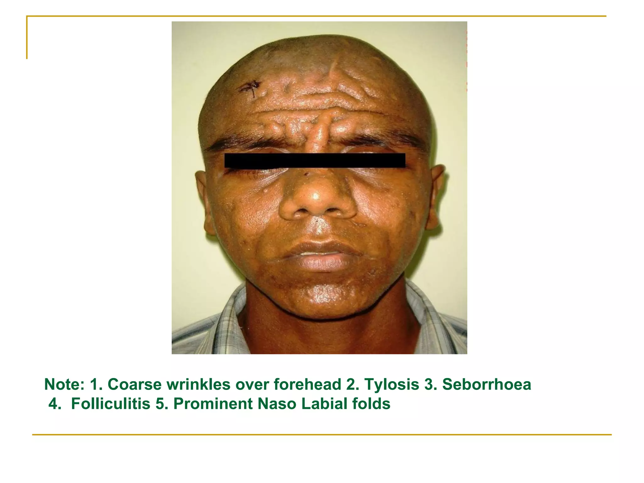 Primary hypertrophic osteoarthropathy (hpoa) | PPT