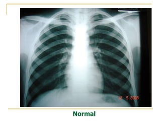 Primary hypertrophic osteoarthropathy (hpoa) | PPT