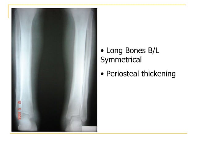 Primary hypertrophic osteoarthropathy (hpoa) | PPT