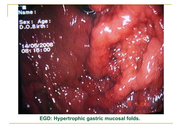 Primary hypertrophic osteoarthropathy (hpoa) | PPT