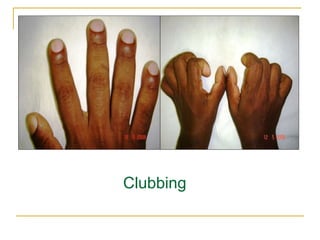 Primary hypertrophic osteoarthropathy (hpoa) | PPT