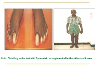 Primary hypertrophic osteoarthropathy (hpoa) | PPT