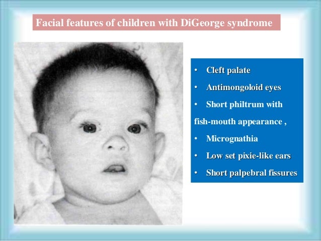 Digeorge Syndrome Genereviews