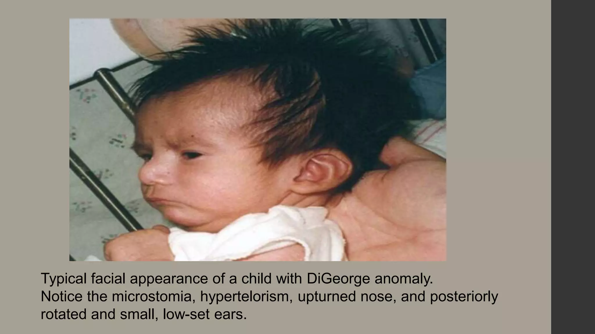 Primary immunodeficiency disorders | PPTX