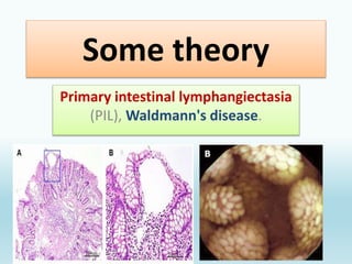 Primary intestinal lymphangiectasia (PIL) case presentation | PPT
