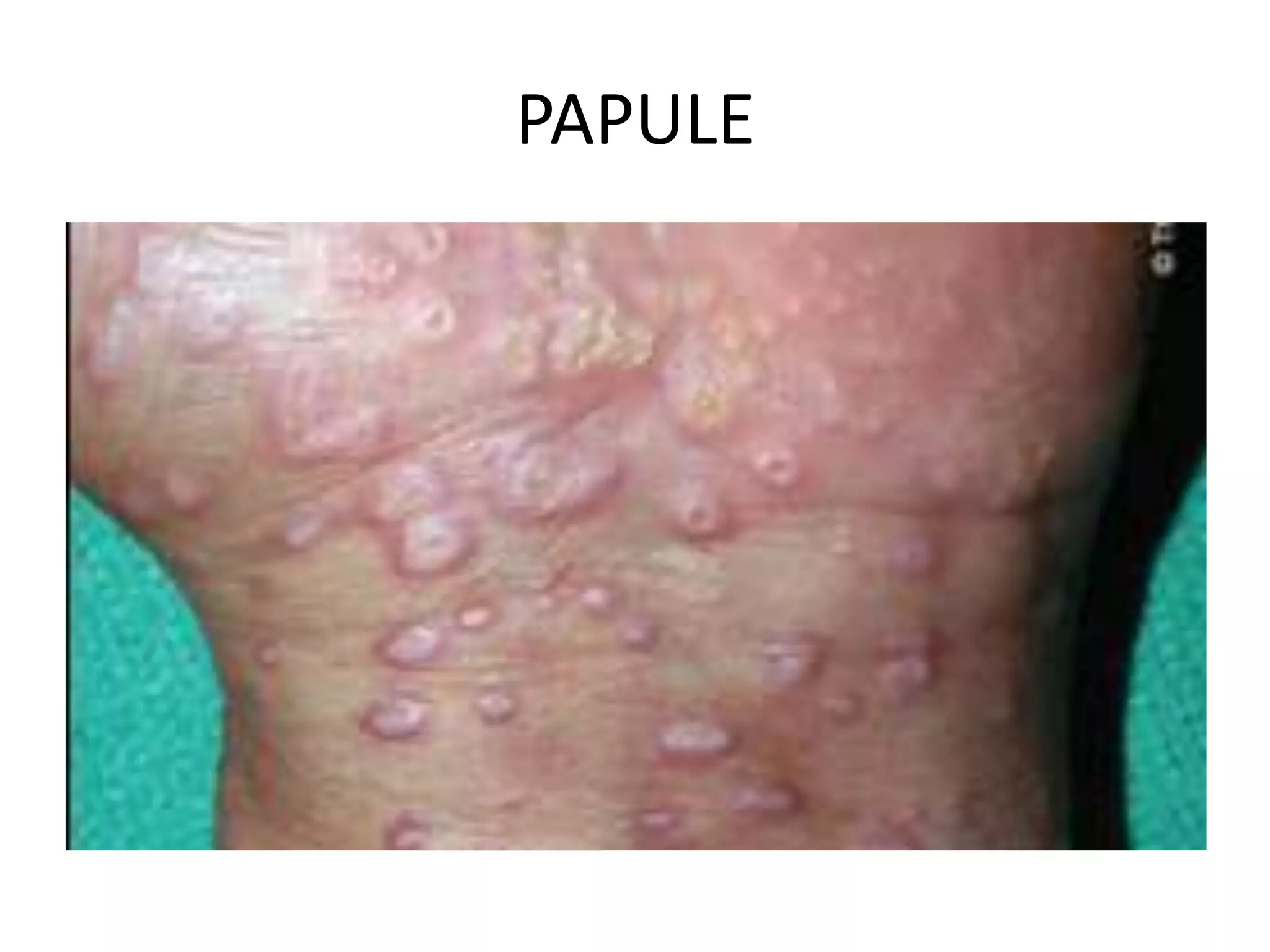Primary Skin Lesions by Aseem | PPTX