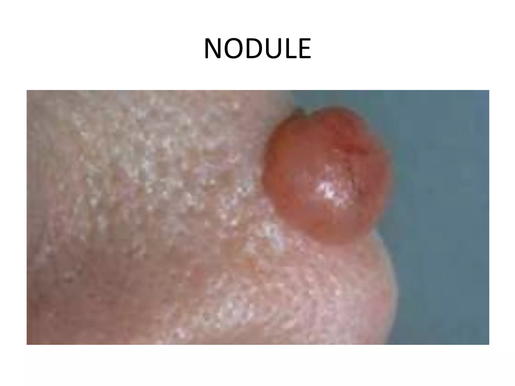 Primary Skin Lesions by Aseem | PPTX