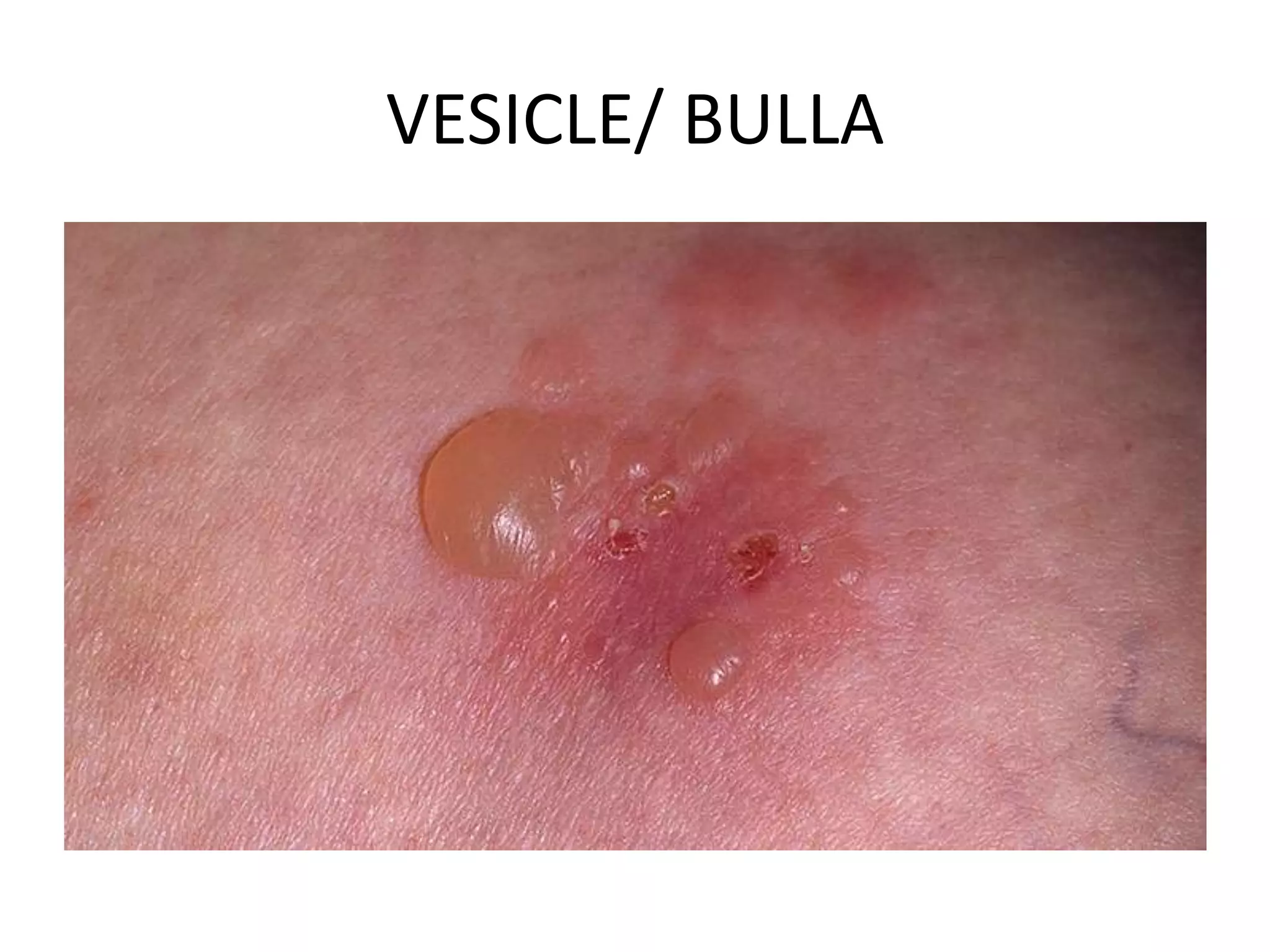 Primary Skin Lesions by Aseem | PPTX