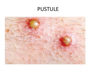 Primary Skin Lesions by Aseem | PPTX