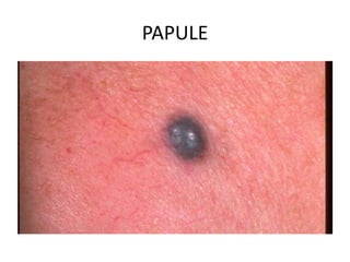 Black Papule