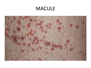 Skin Macule