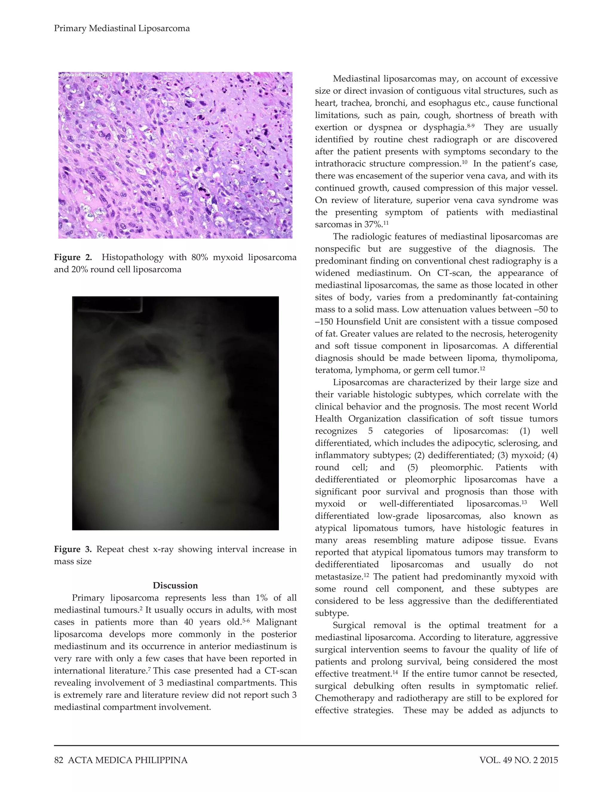 Primary mediastinal liposarcoma of the superior, middle, and anterior mediastinum | PDF