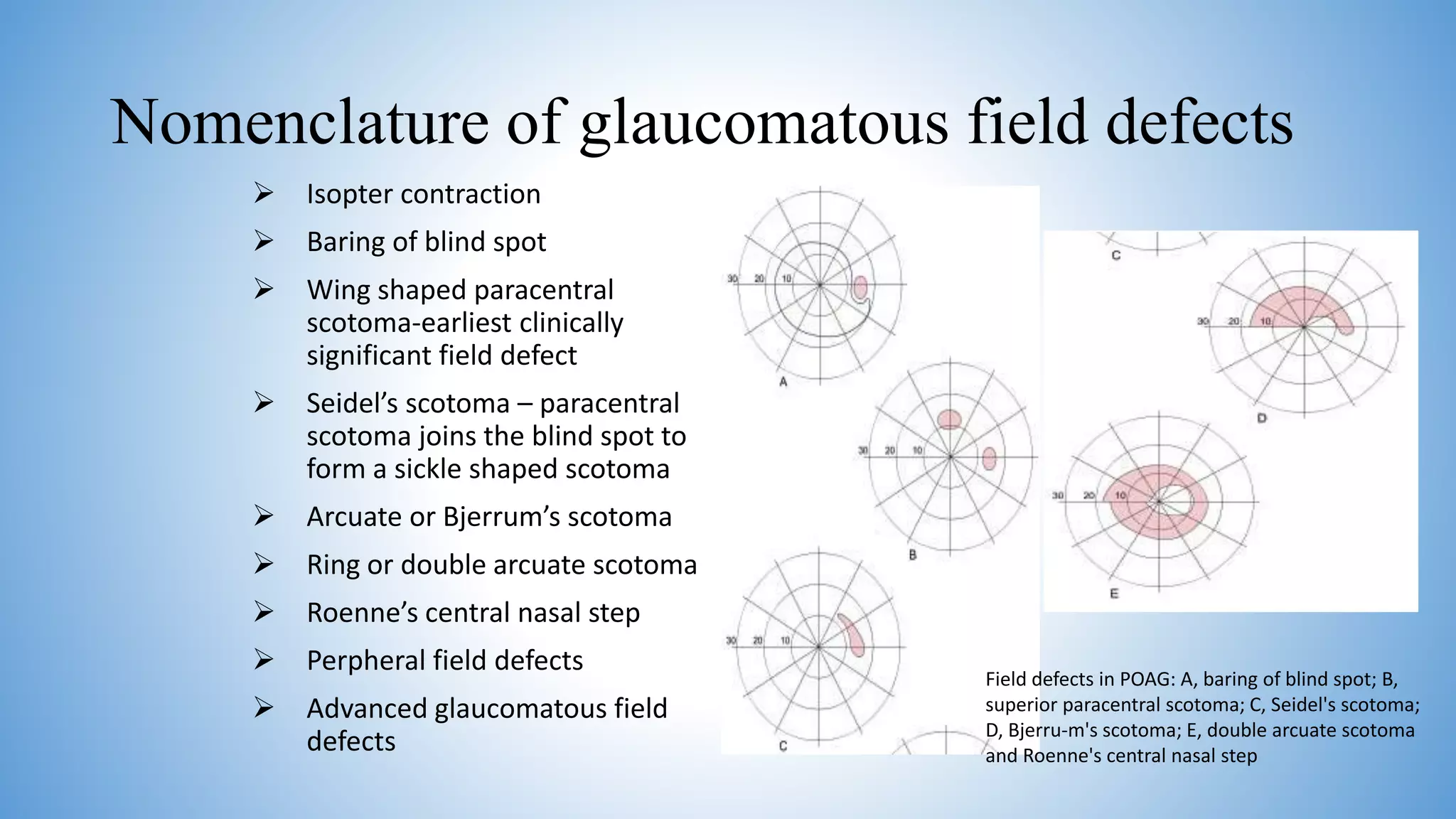 Primary open angle glaucoma | PPTX