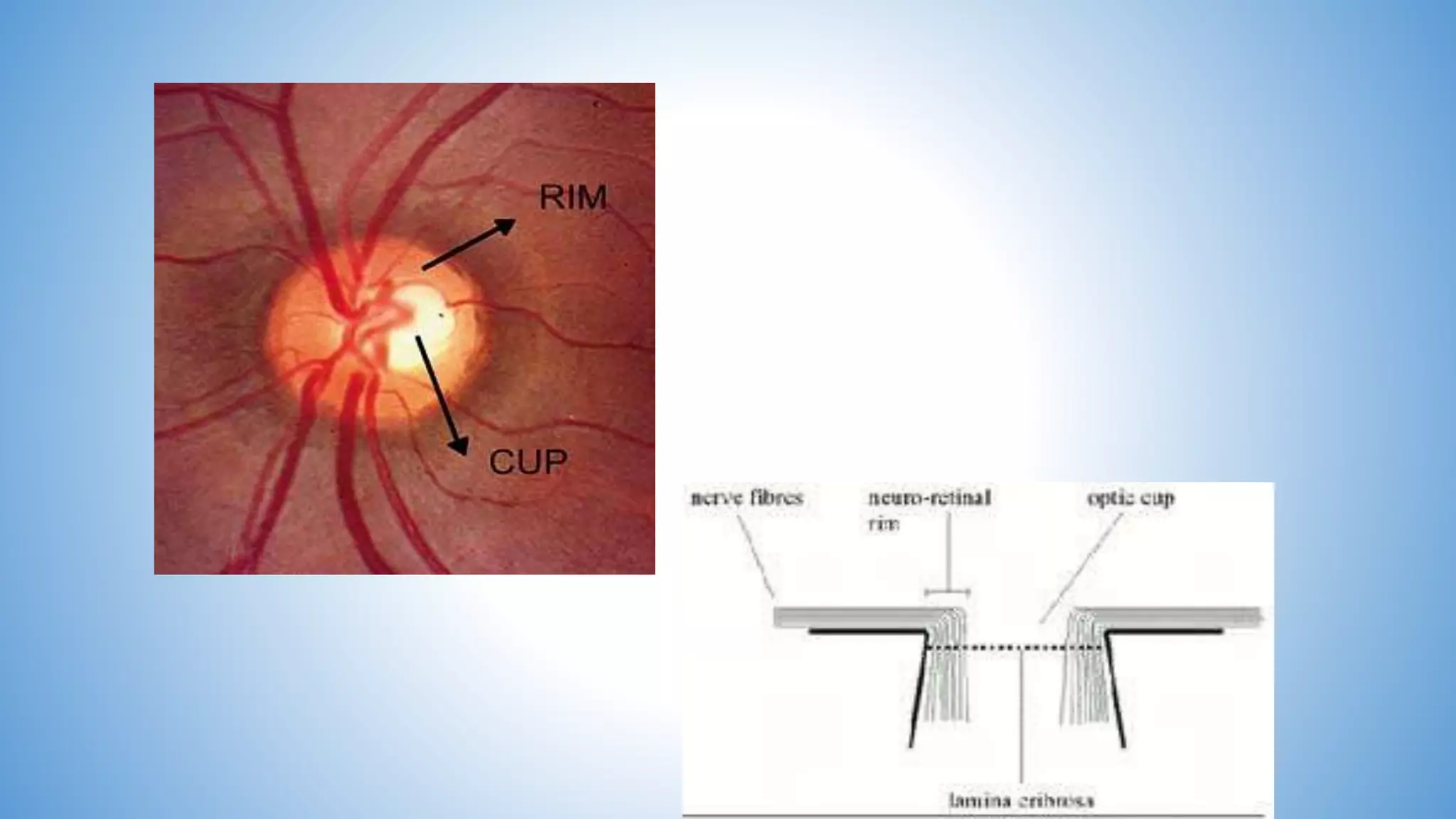 Primary Open Angle Glaucoma Pptx