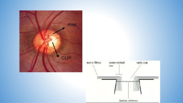 Primary open angle glaucoma