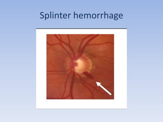 Primary open angle glaucoma | PPT